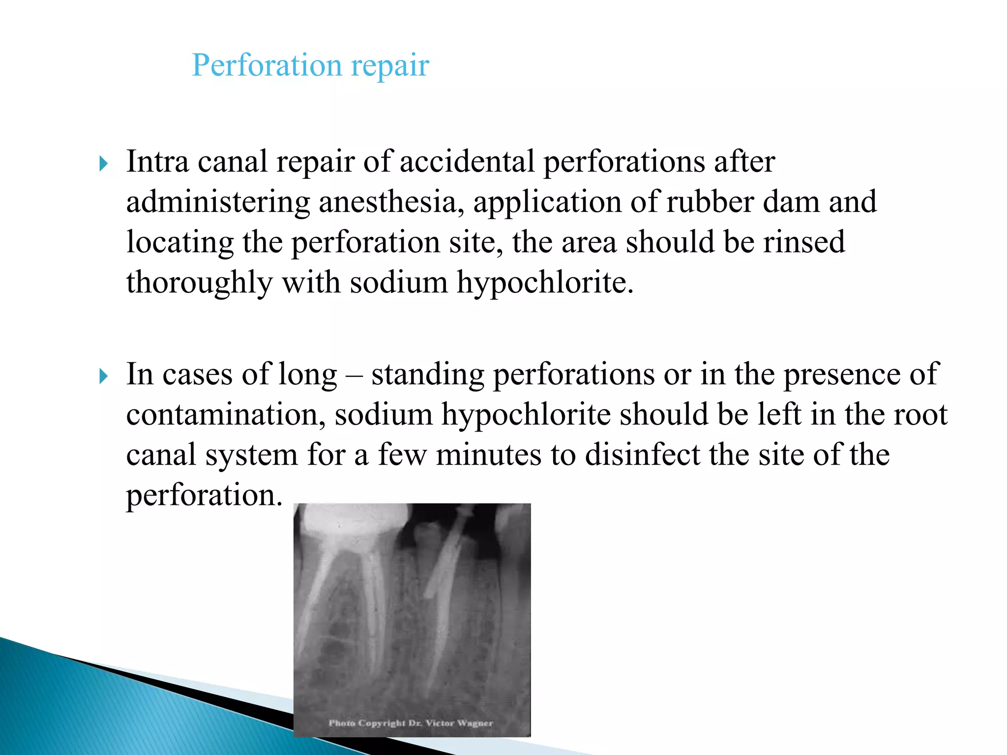 Root repair materials | PDF