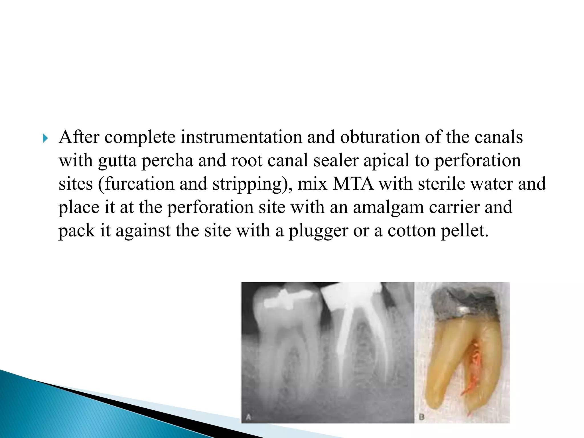 Root repair materials | PDF