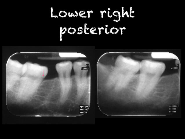 Generealized cervical resorption case present | PPT