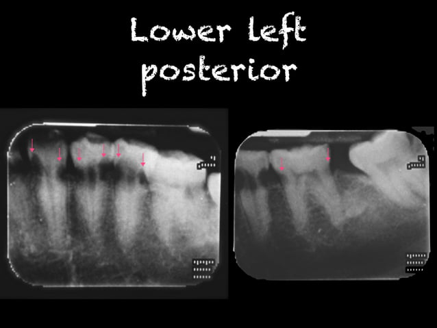 Generealized cervical resorption case present | PPT