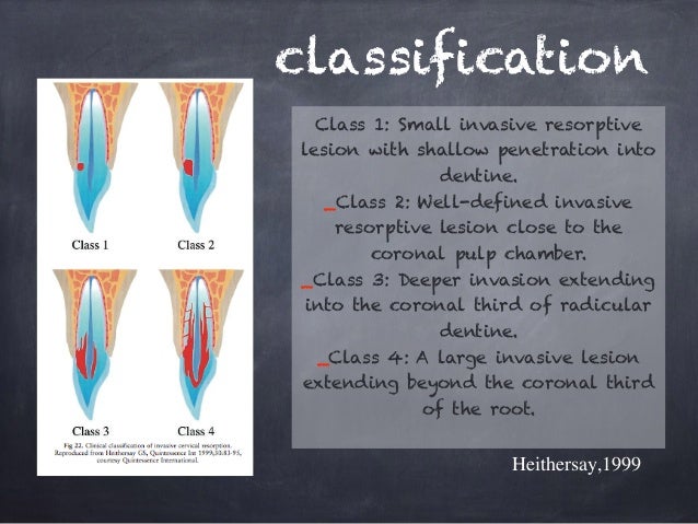 Generealized cervical resorption case present