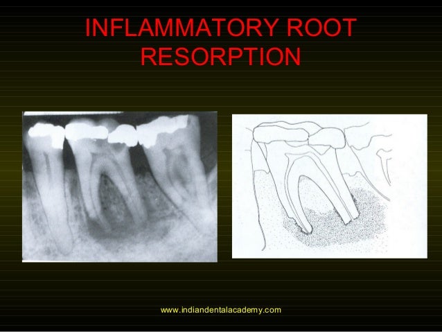 Root resorption/ dental courses