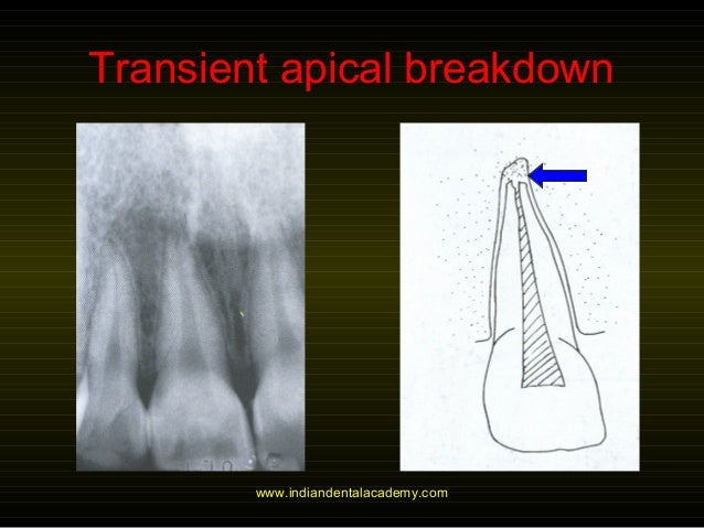 Root resorption/ dental courses
