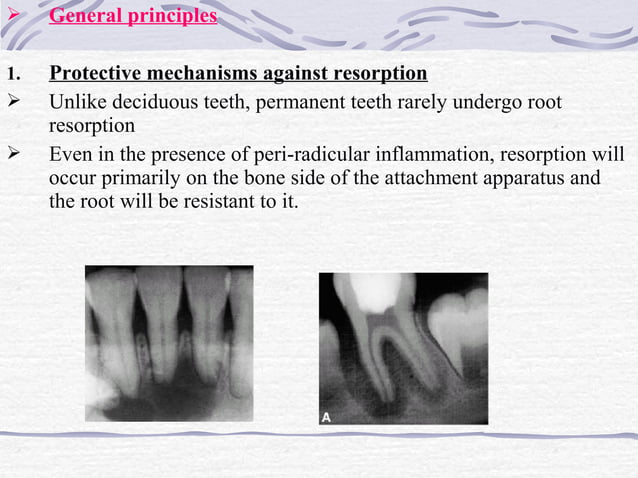 Root resorption | PPT