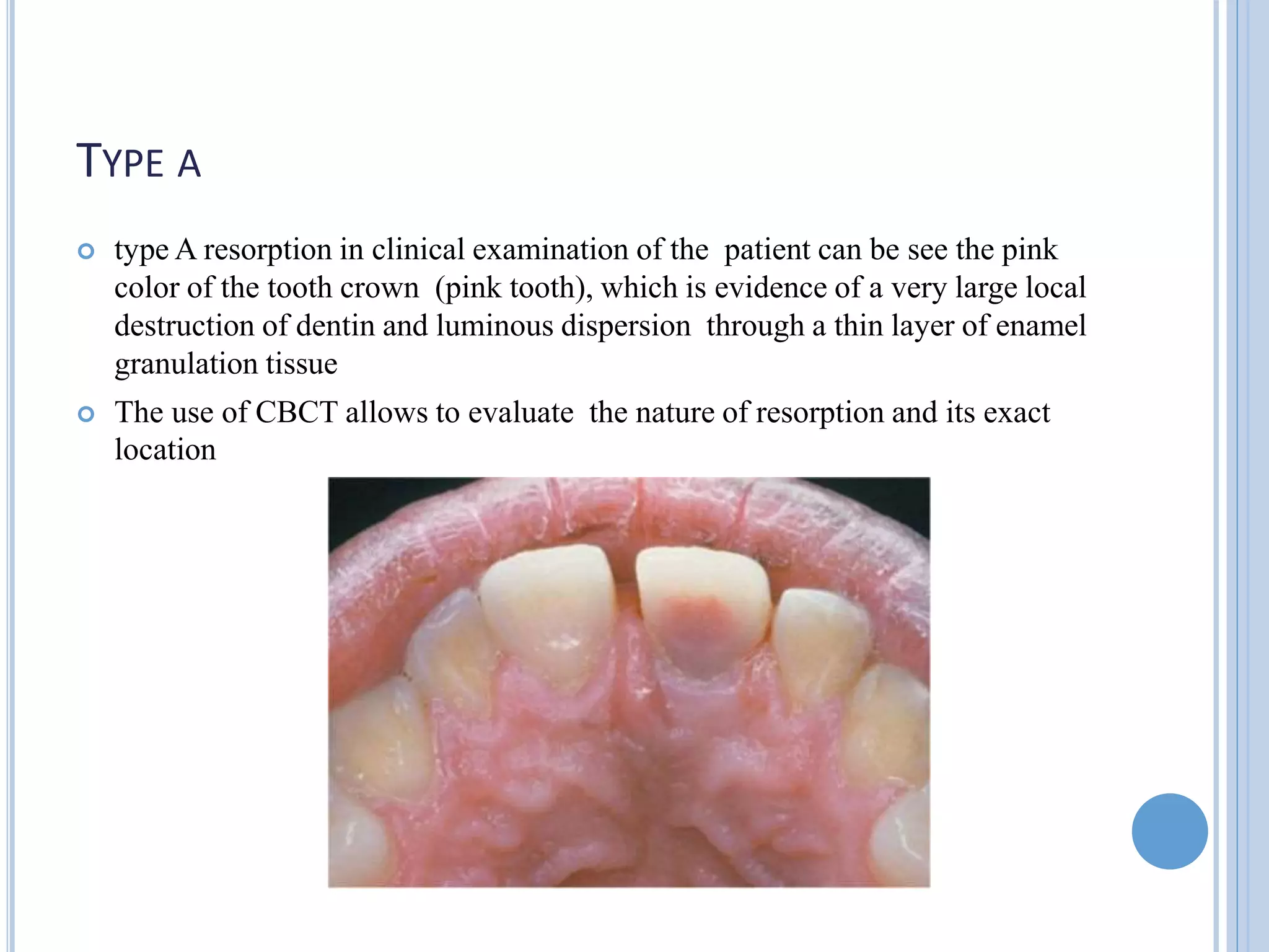 Root resorption | PPTX