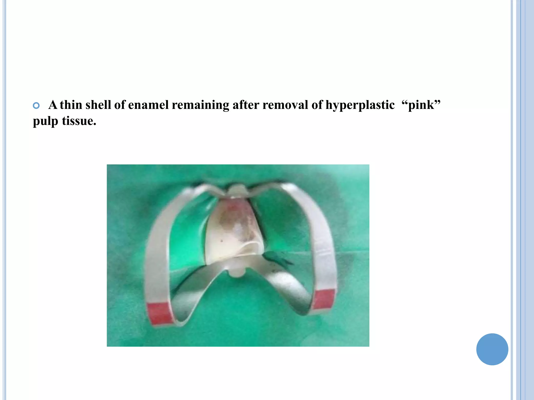 Root resorption | PPTX