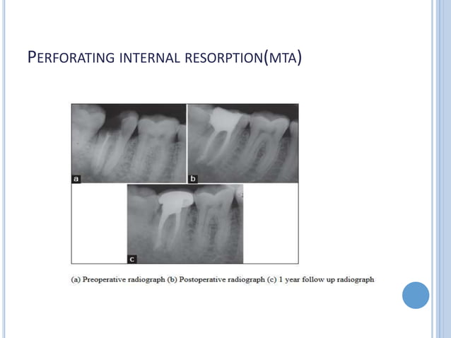 Root resorption | PPTX | Dental Health | Diseases and Conditions