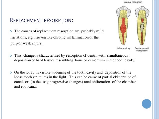 Root resorption