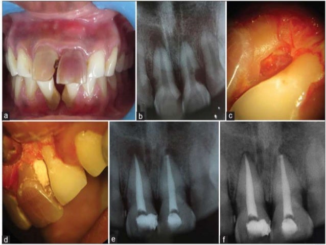 Root resorption