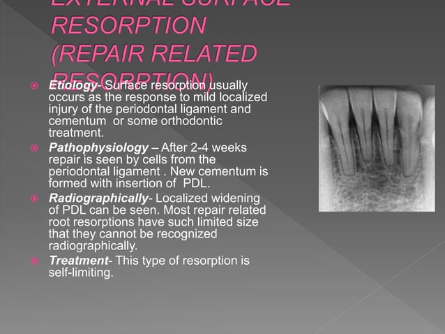 root resorption.ppt