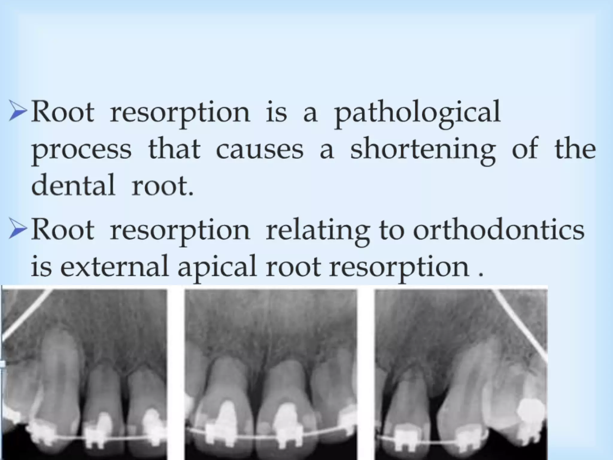 Orthodontics Management of root resorption _ Departement orthodontic ...