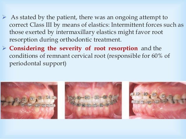 Orthodontics Management of root resorption _ Departement orthodo…