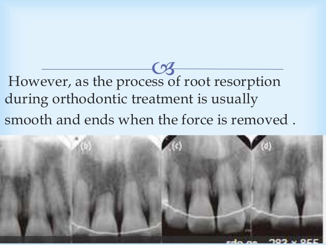 Orthodontics Management of root resorption _ Departement orthodo…