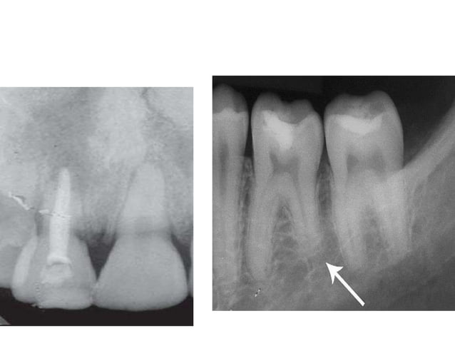 Root Resorption Bds 5ppt
