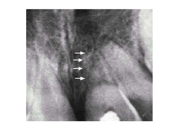 Root Resorption Bds 5ppt