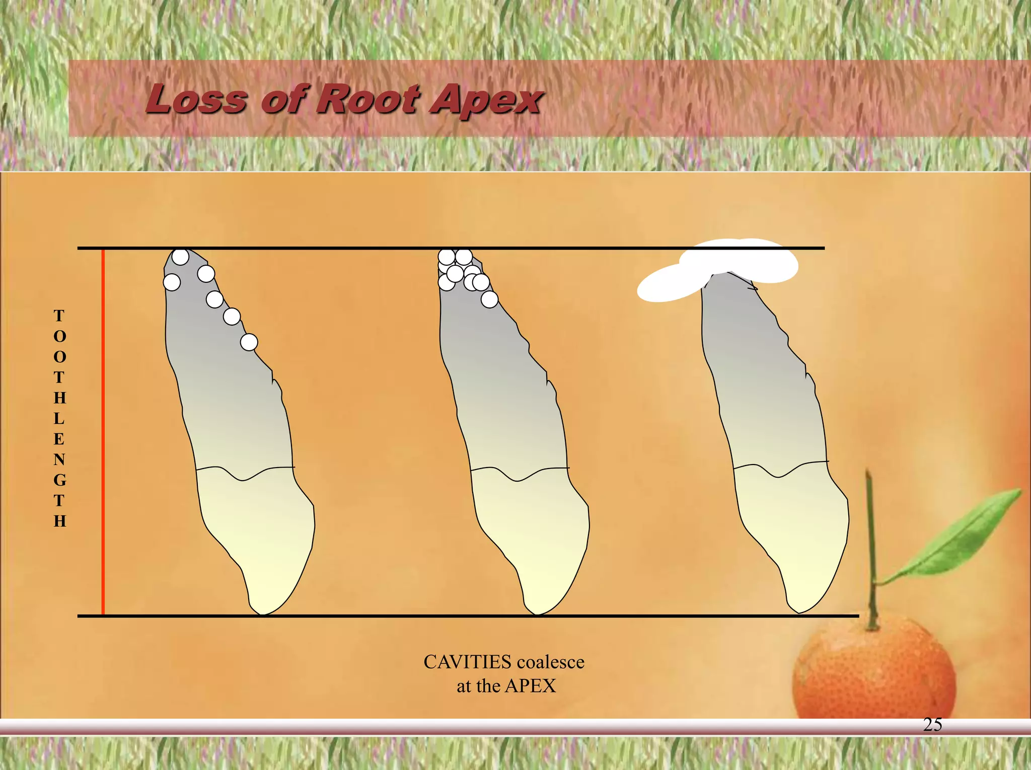 ROOT RESORPTION IN ORTHODONTICS | PPT