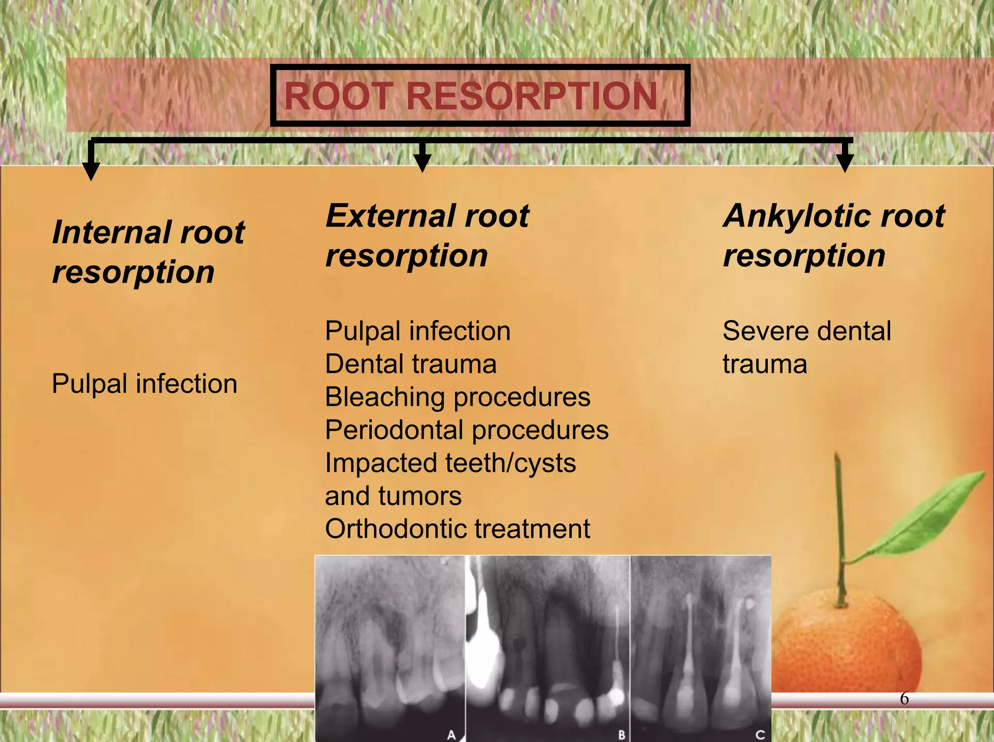 ROOT RESORPTION IN ORTHODONTICS | PPT