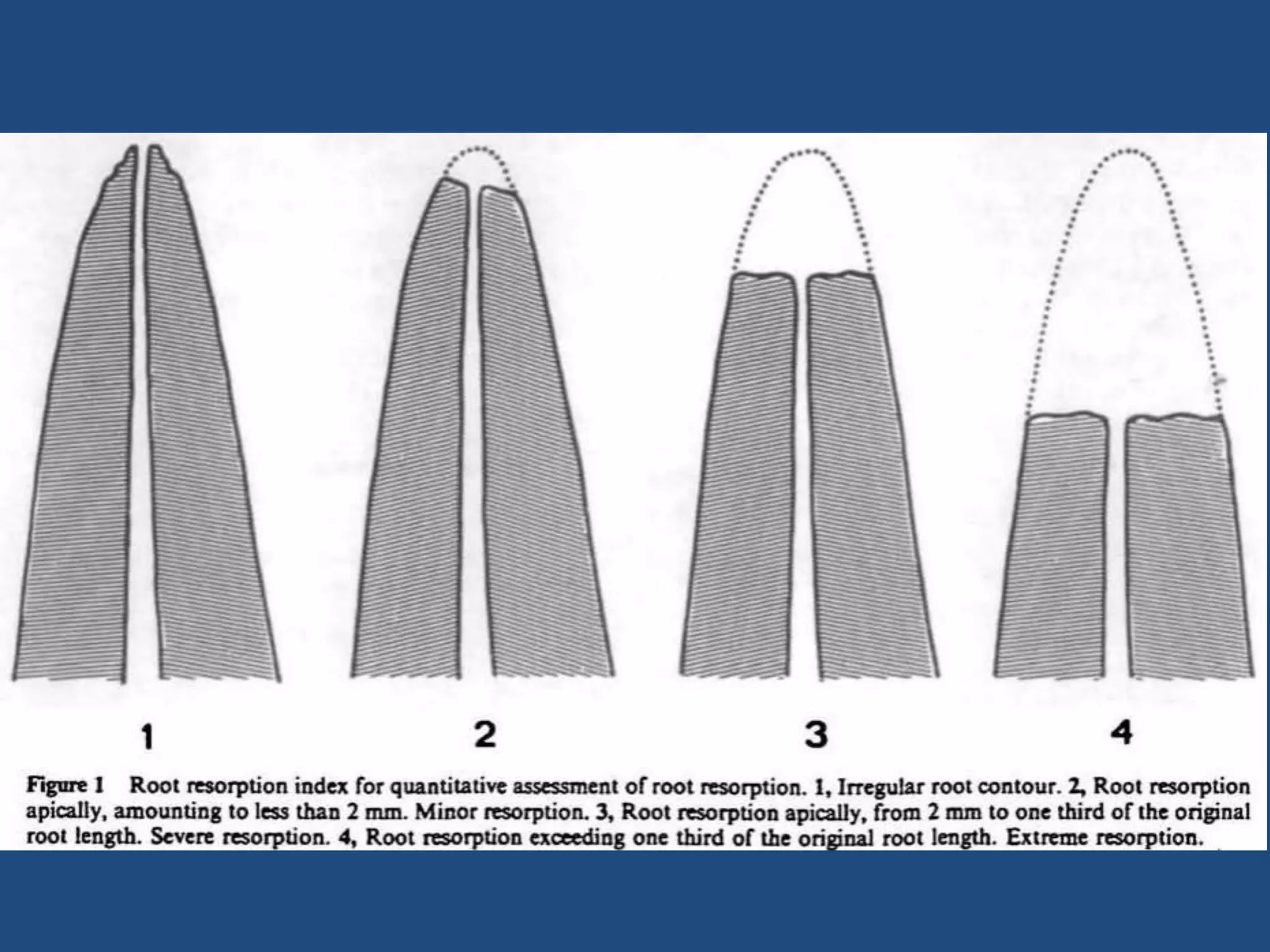Root resorption in orthodontics.pptx