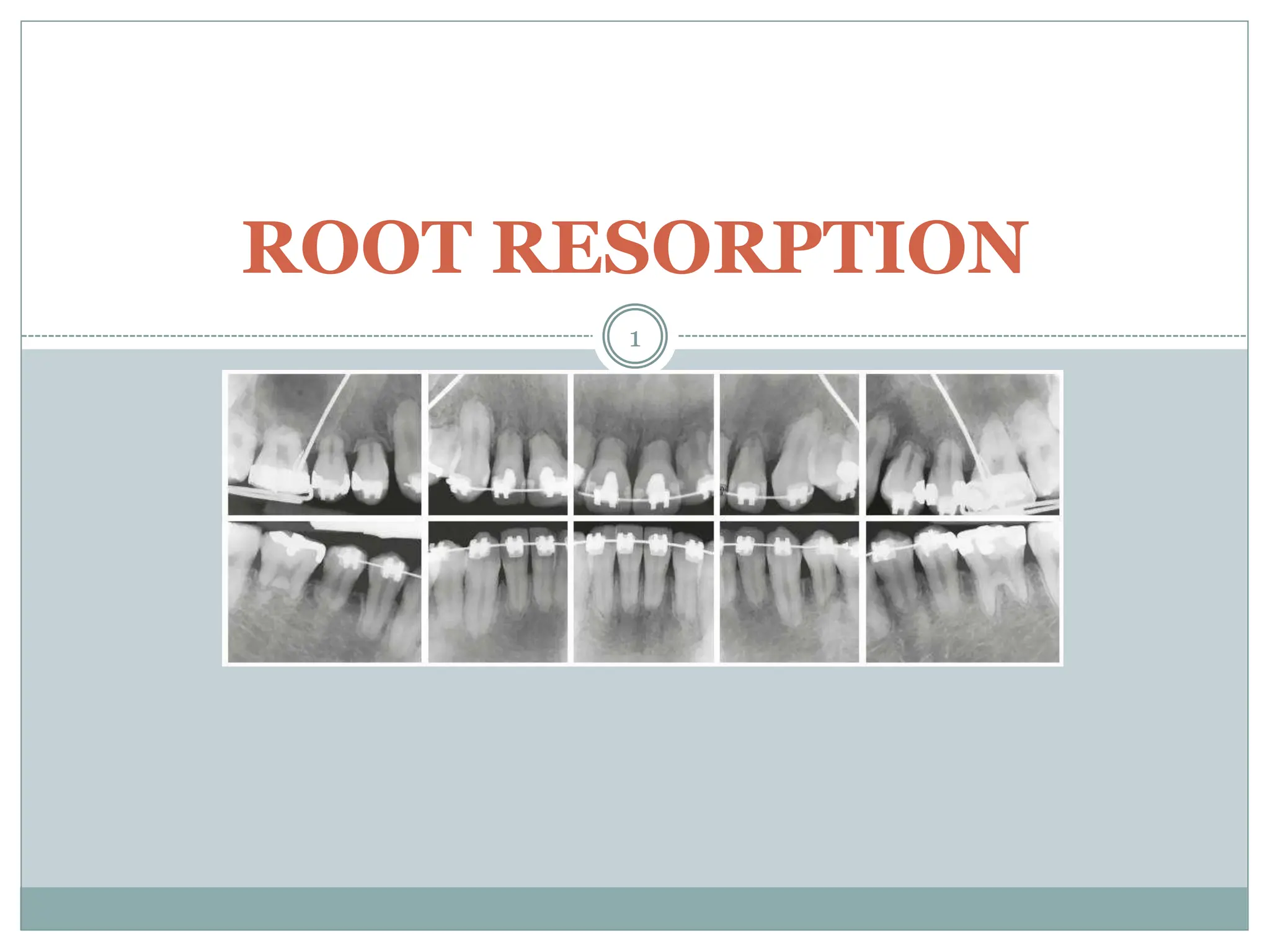 ROOT RESORPTION SEMINAR Root resorption is a pathological and ...