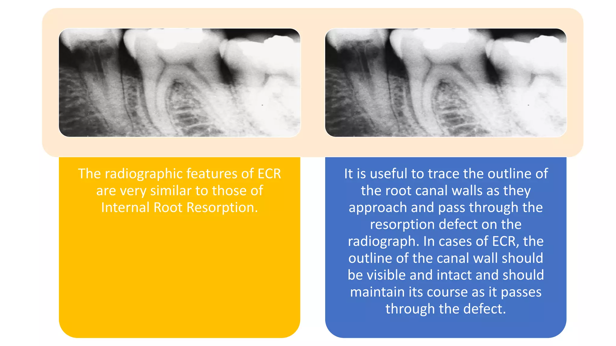 Root Resorption | PDF