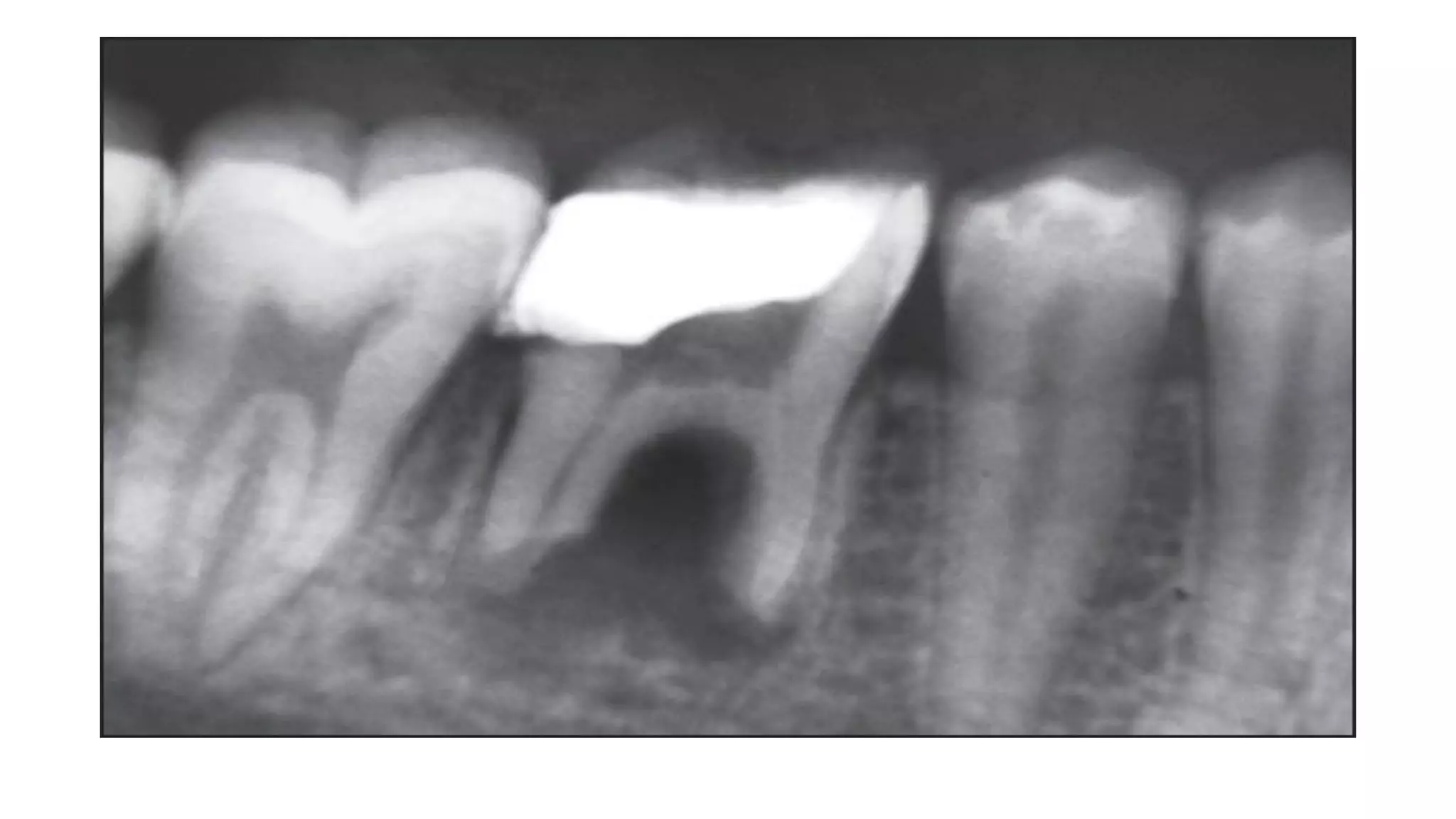 Root Resorption | PDF