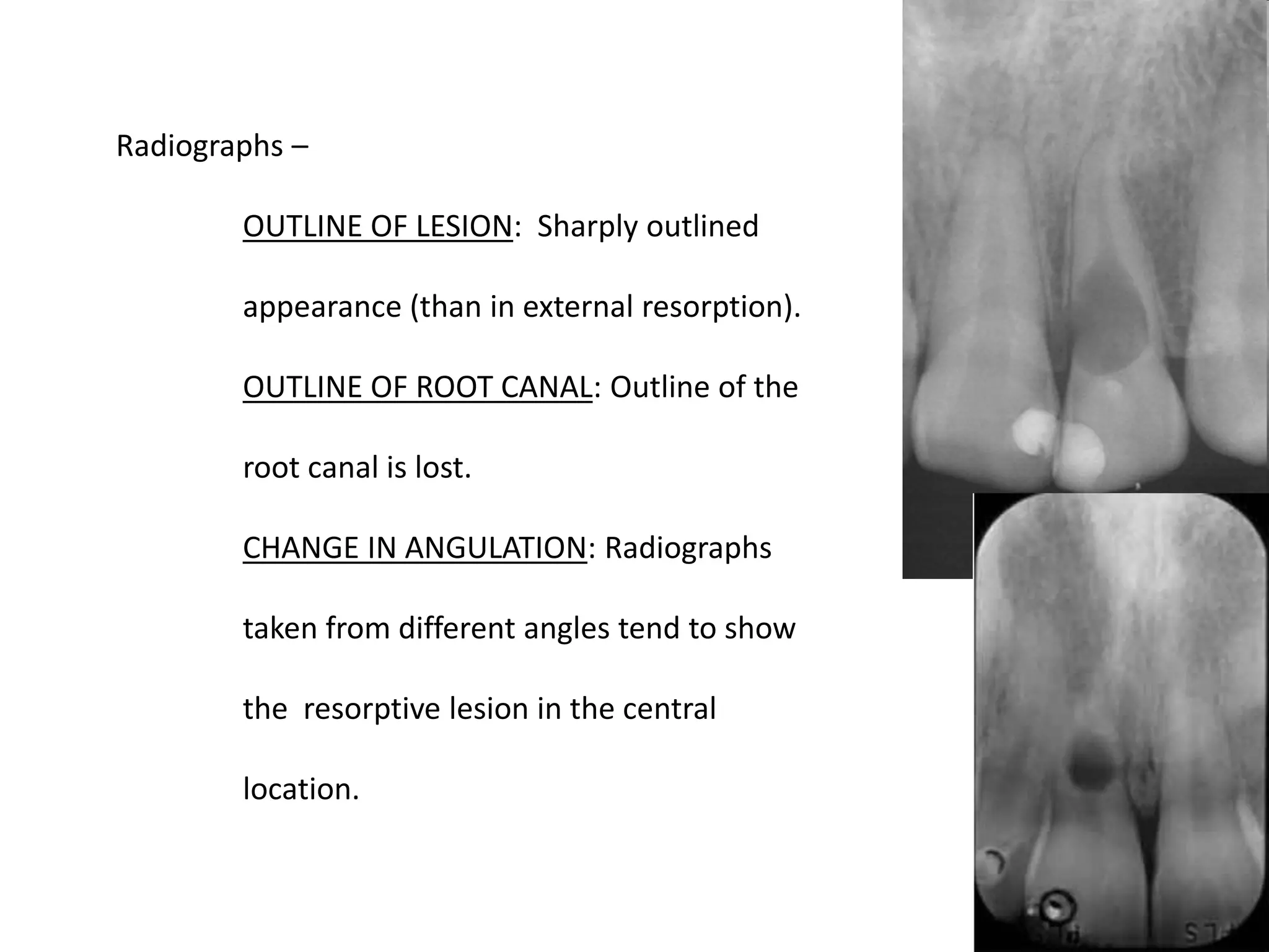 Root Resorption Ppt