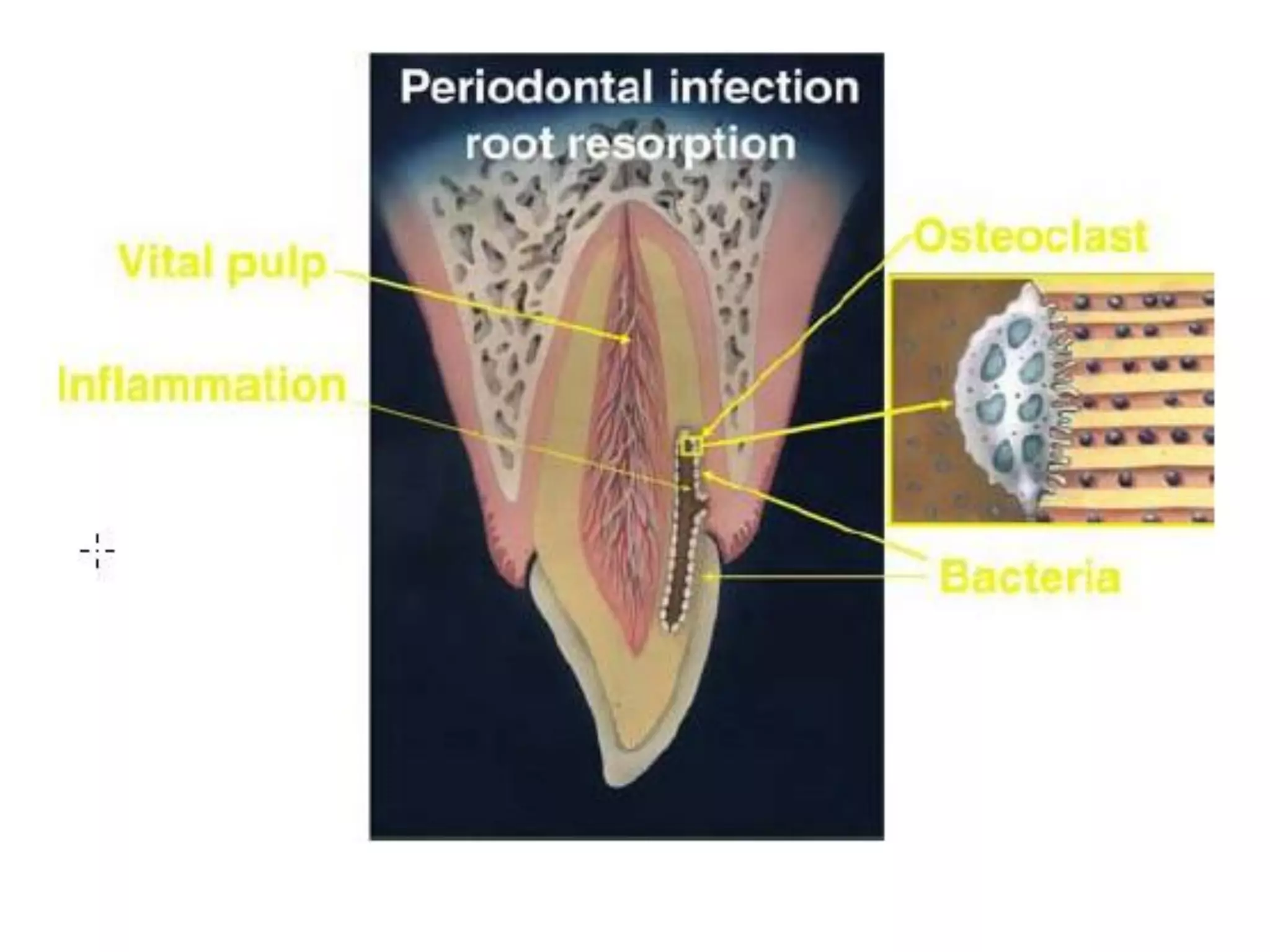 Root Resorption | PDF