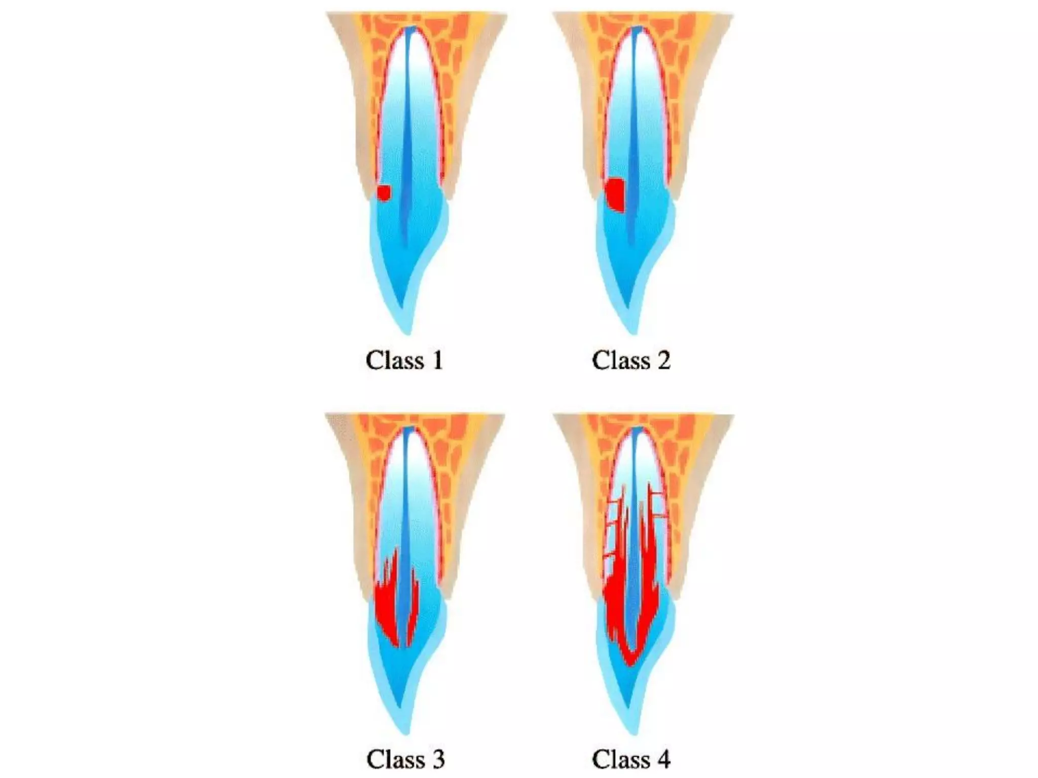 Root Resorption | PDF