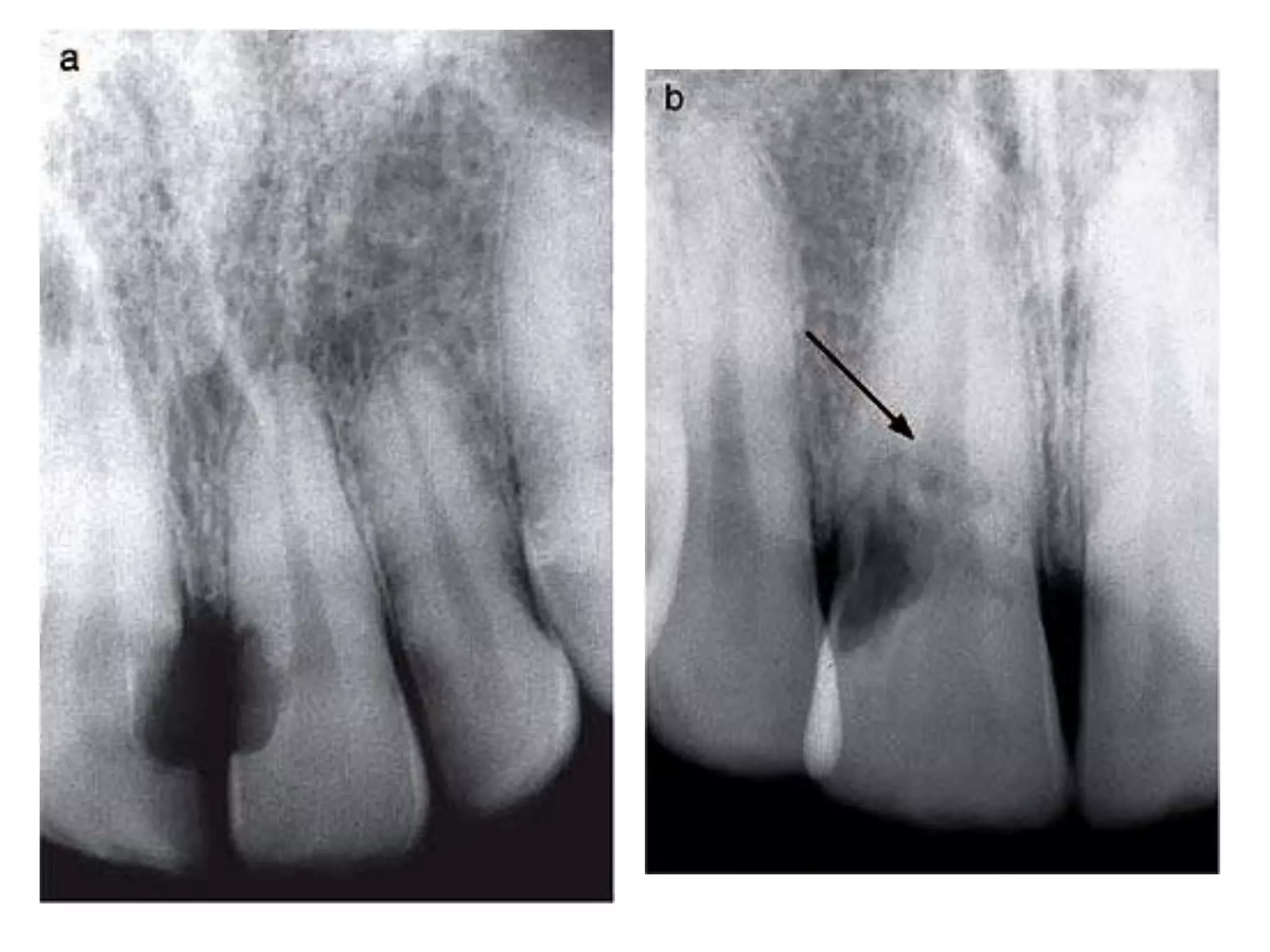 Root Resorption | PDF