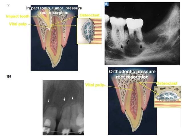 Root Resorption | PDF