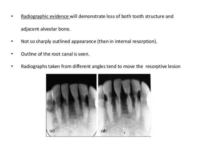 Root Resorption
