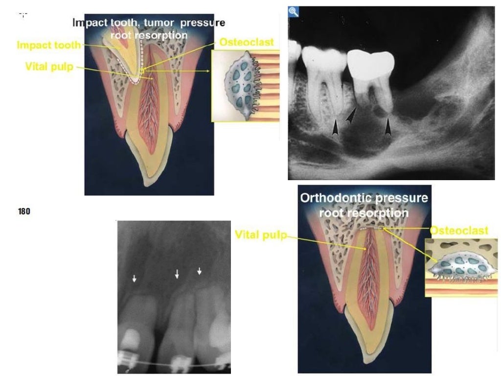 Root Resorption