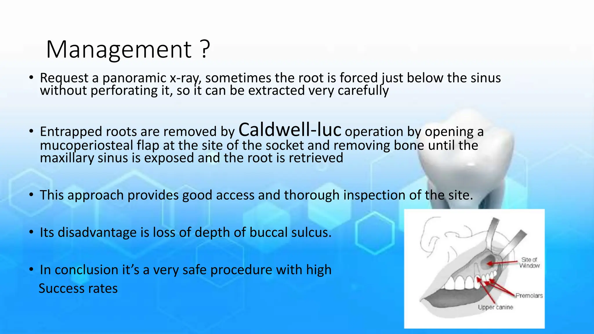 Management of root entrapment in maxillary sinus .pptx