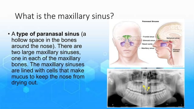 Management of root entrapment in maxillary sinus .pptx