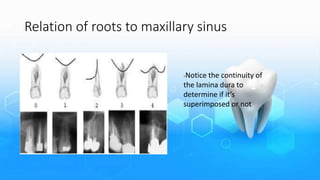 Management of root entrapment in maxillary sinus .pptx