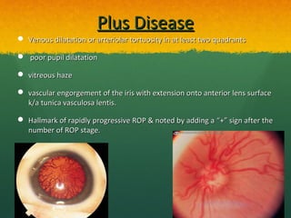 Retinopathy Of Prematurity Plus Disease