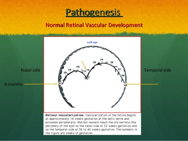Retinopathy of prematurity