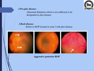 Retinopathy of pre-maturity (ROP) | PDF