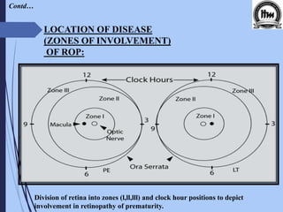 Retinopathy of pre-maturity (ROP) | PDF