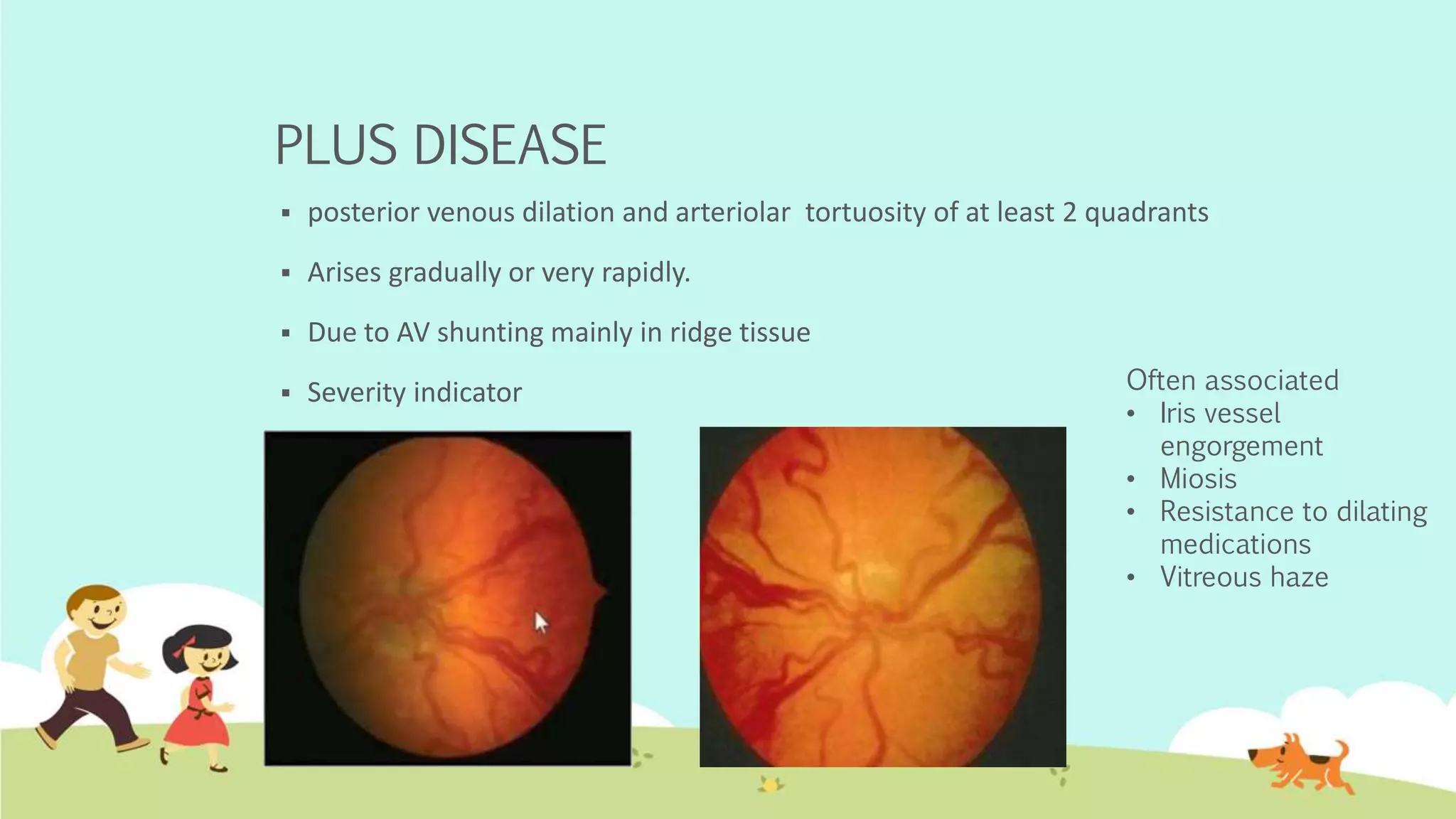 Retinopathy of prematurity | PPTX