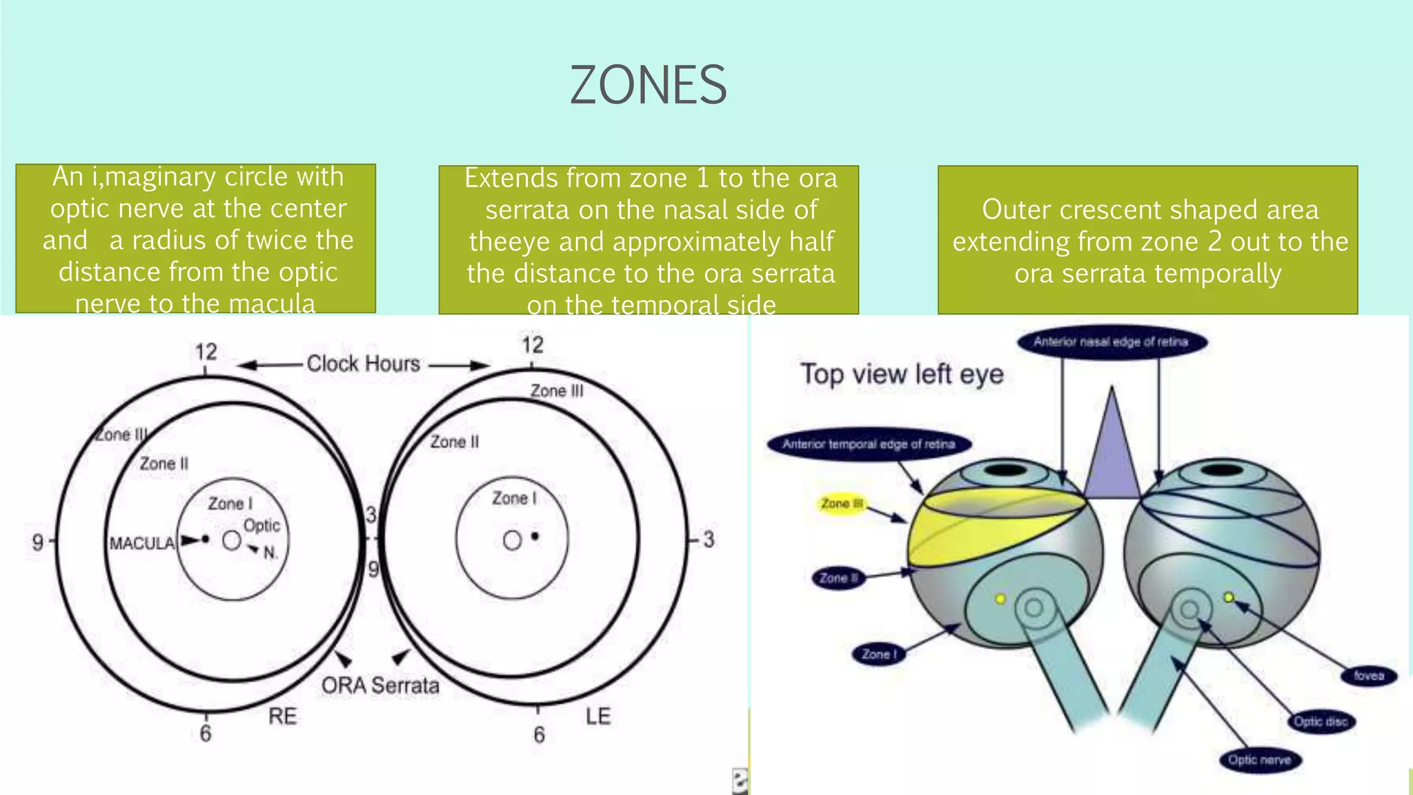Retinopathy of prematurity | PPTX