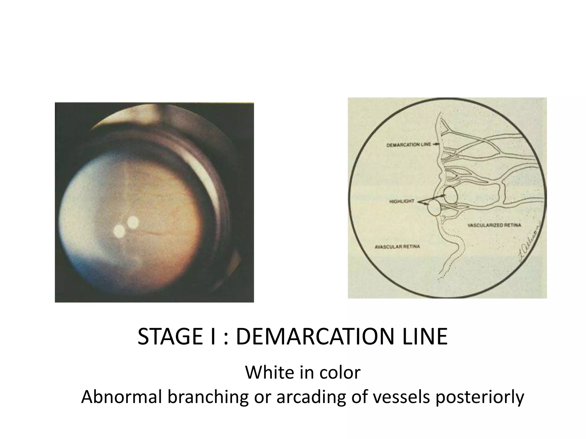 Rop Retinopathy of prematurity | PPT