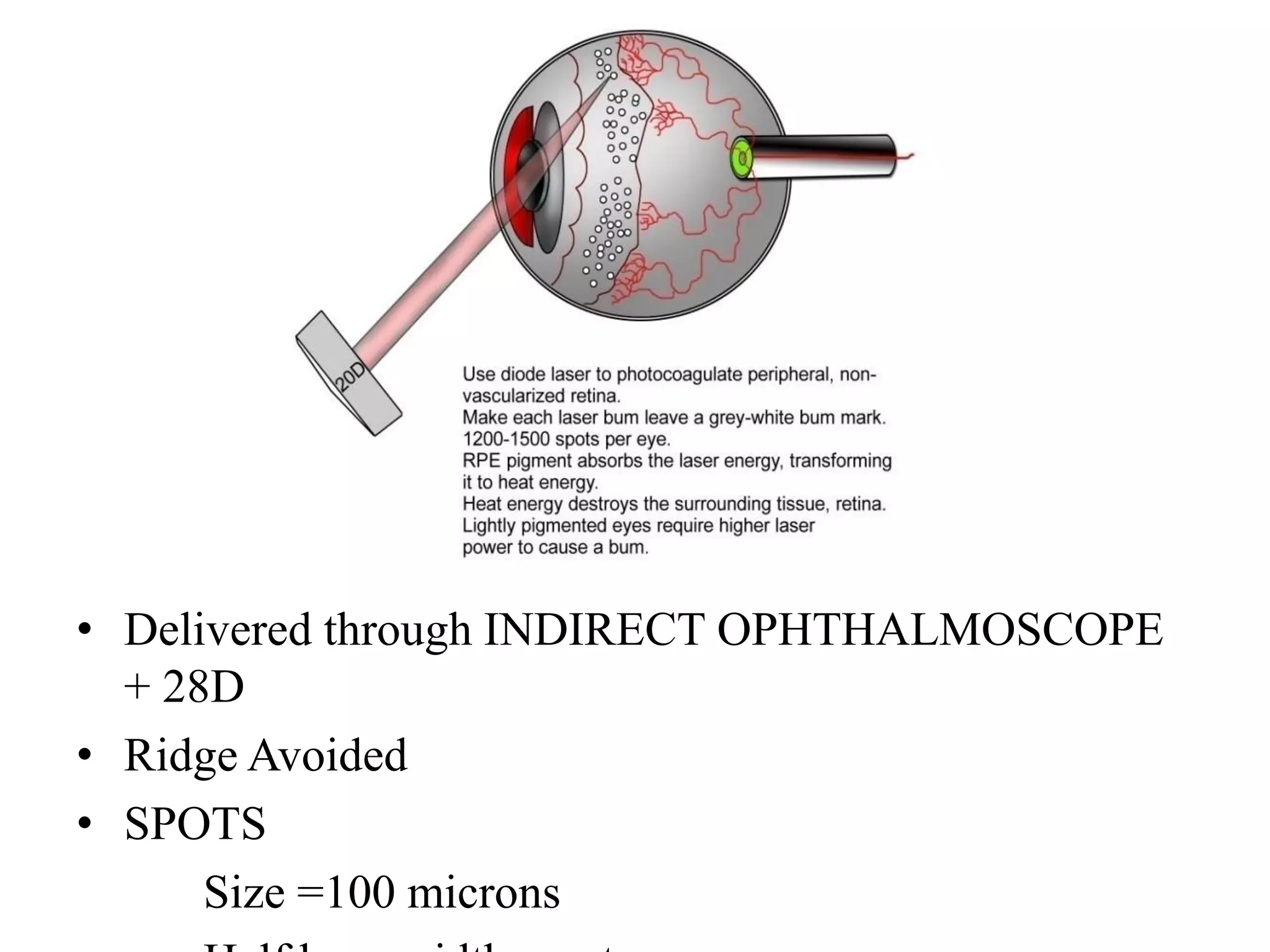 Rop Retinopathy of prematurity | PPT