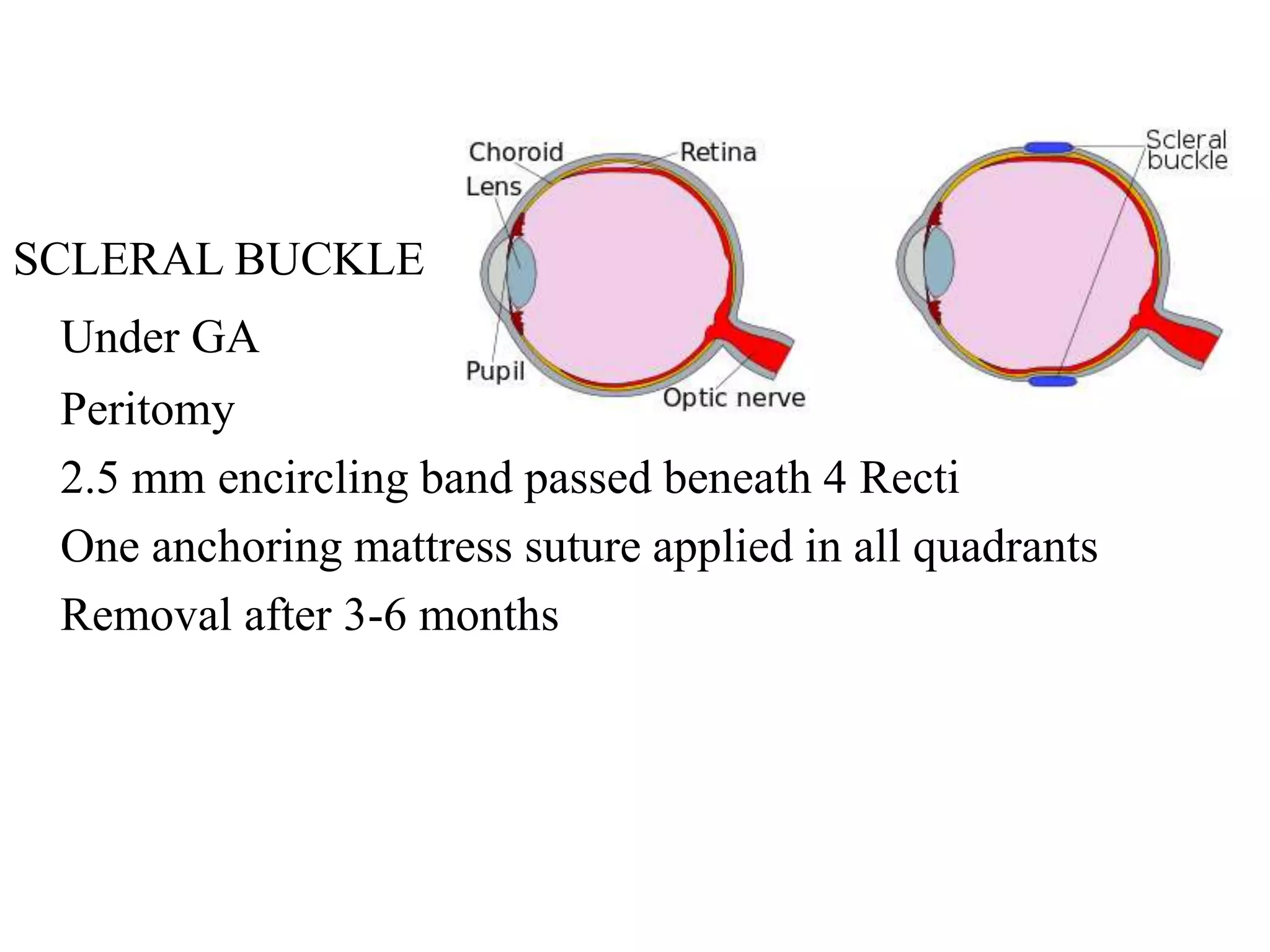 Rop Retinopathy of prematurity | PPT