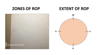 Retinopathy of Prematurity.pptx