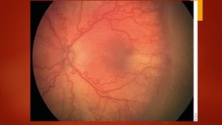 RETINOPATHY OF PREMATURITY | PPTX