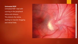 RETINOPATHY OF PREMATURITY | PPT