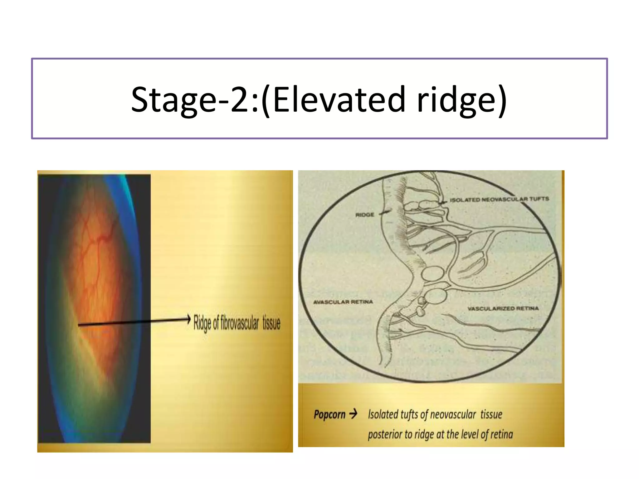 Retinopathy of Prematurity | PPTX