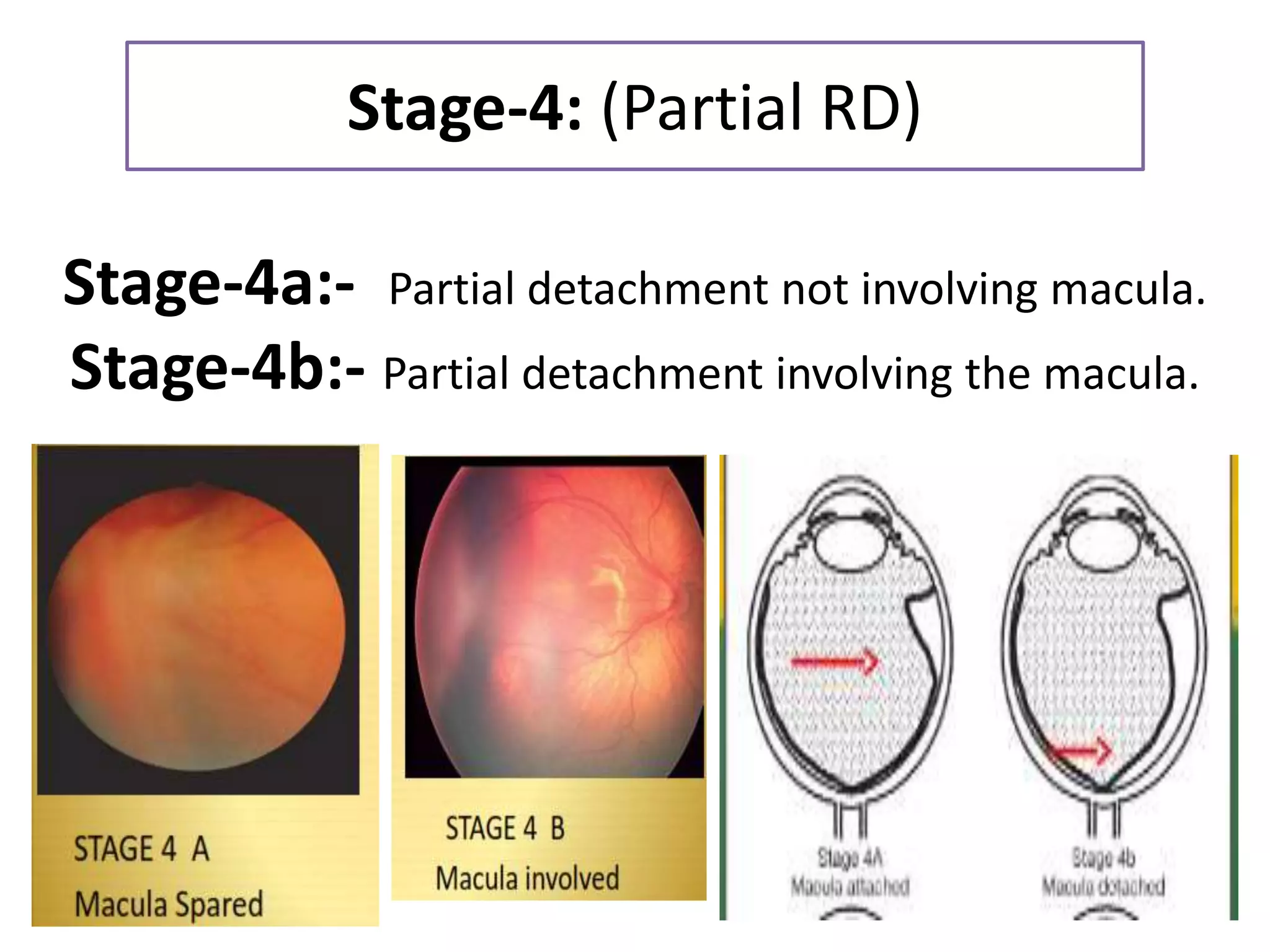 Retinopathy of Prematurity | PPTX