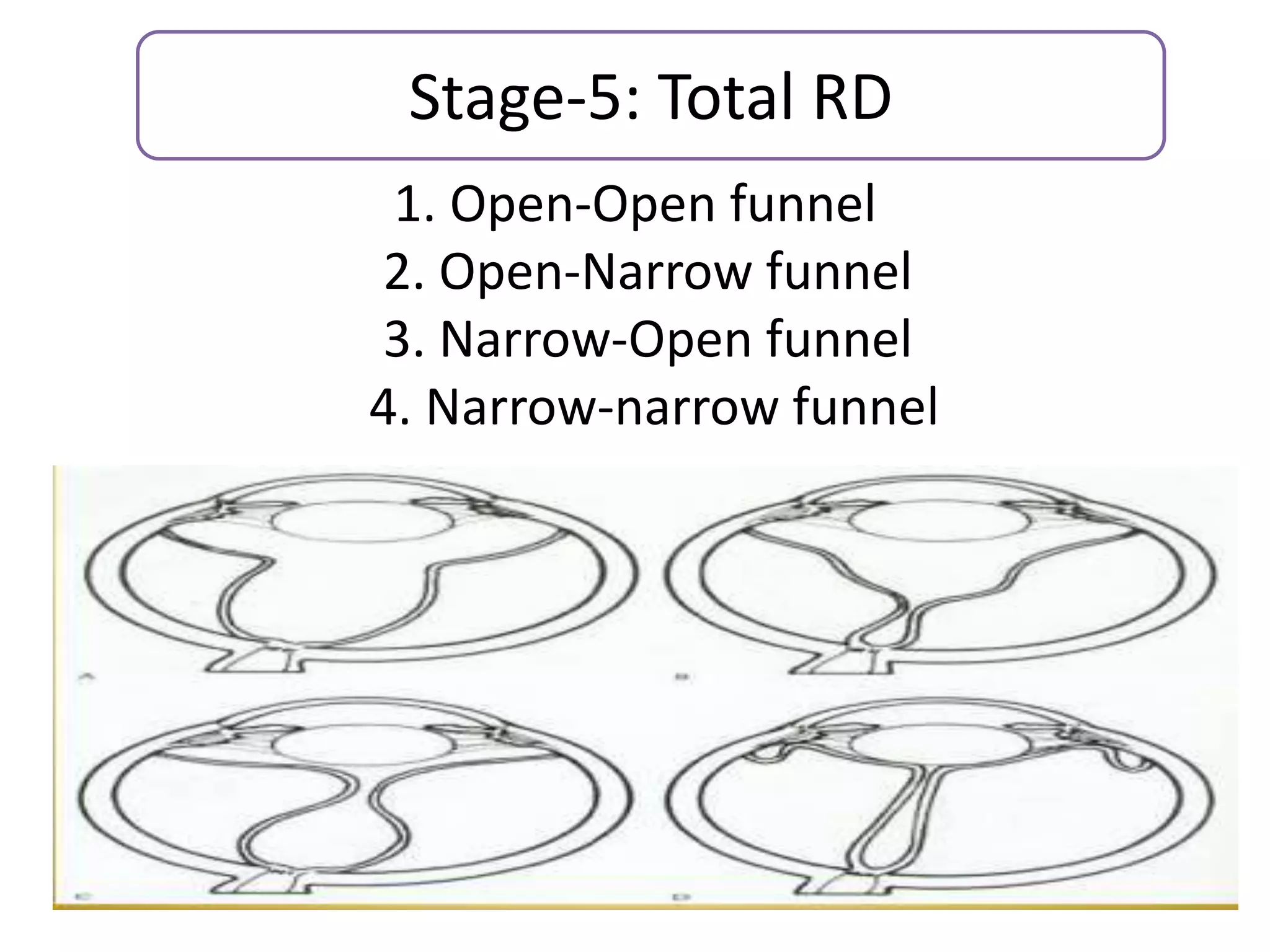 Retinopathy of Prematurity | PPTX